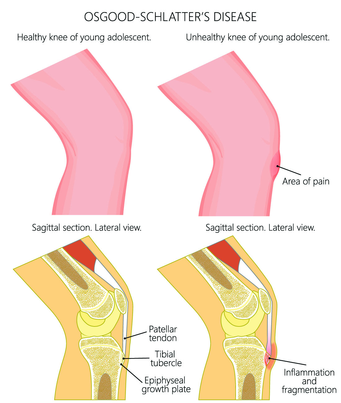 Growing pains in knee store